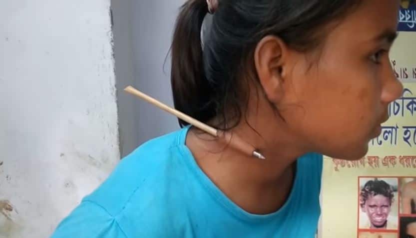 Arrow pierces neck of 14-year old Indian archer at Bolpur