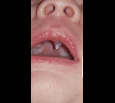 This Baby Grew A Fang Tooth Overnight, Know What Happened To This Baby ...