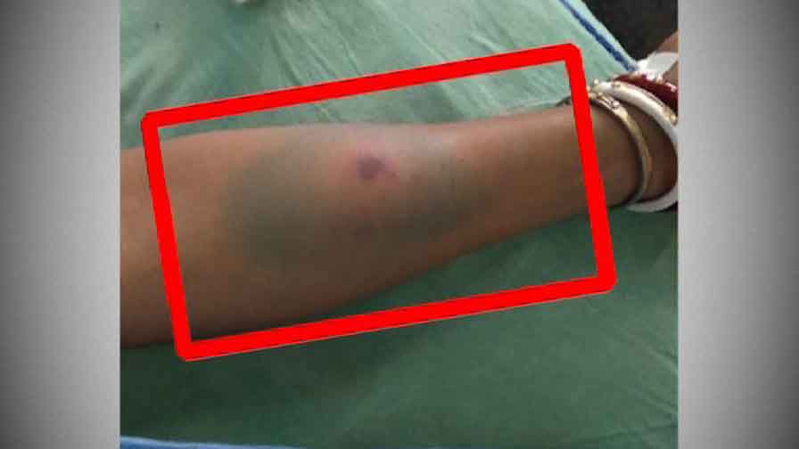Baidyabati woman dies of insect bite | শৌচাগারে পোকার কামড়, সঙ্গে ...
