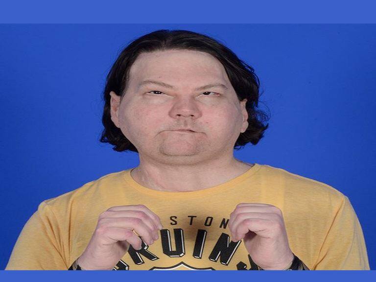 New Jersey 22-Year-Old Joe DiMeo Gets World First Double Hand Face ...